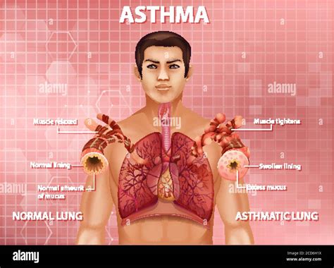 Human Anatomy Asthma Diagram Illustration Stock Vector Image Art Alamy