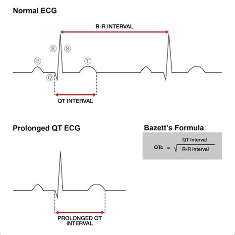 ECG Diagnosis The Effect Of Ionized Serum Calcium Levels On