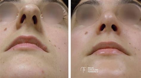 Rinoplastia Clínica do Nariz e Face Especialistas em face
