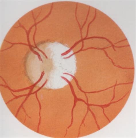 La Scl Rose En Plaque Cabinet D Ophtalmologie Du Dr Elgolli