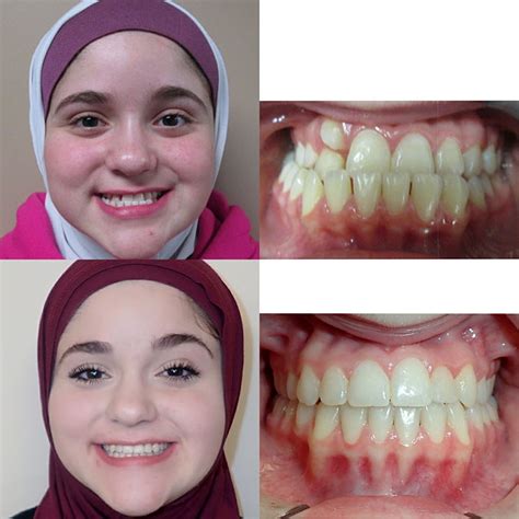 Before After Braces Wazio Orthodontics
