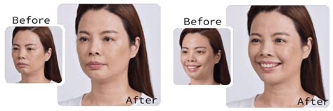 Teoxane
