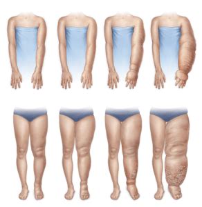 Linfedema Qué es cuál es su causa y qué podemos hacer para tratarlo