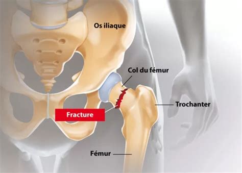 Rééducation de la fracture col du fémur chez la personne âgée Centre