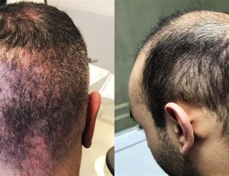 Enfermedades detrás de la pérdida de cabello