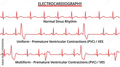 Set Of ECG Common Abnormalities Normal Sinus Rhythm Uniform And