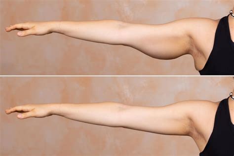 How To Get Rid Of Upper Arm Fat 10 Best Exercises