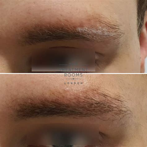 How Does An Eyebrow Hair Transplant Work Contact Us