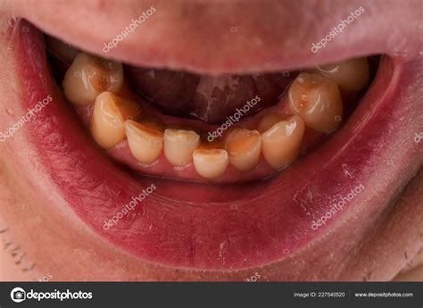 Malocclusion Crowding Teeth Lower Jaw Close Man Mouth Crooked Teeth