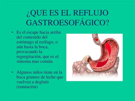 PPT REFLUJO GASTROESOFÁGICO EN NIÑOS PowerPoint Presentation free