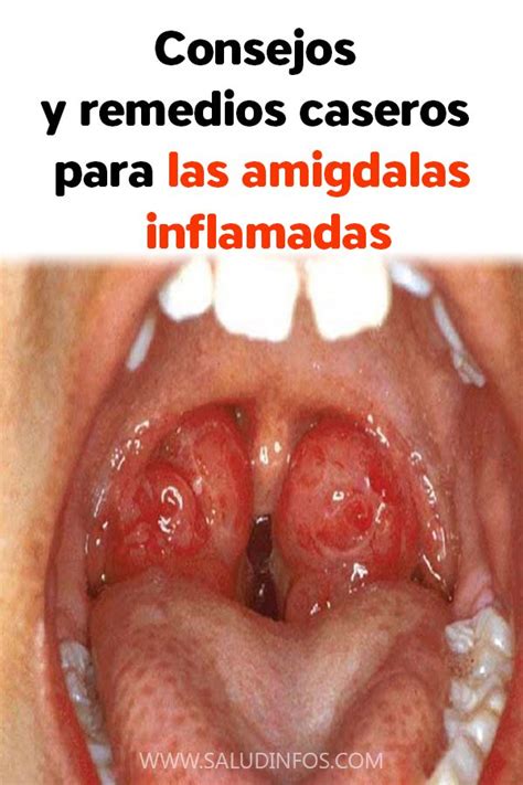 Consejos Y Remedios Caseros Para Las Amigdalas Inflamadas Consejos
