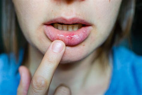 Remedios Caseros Para Las Heridas En La Boca Mejor Con Salud