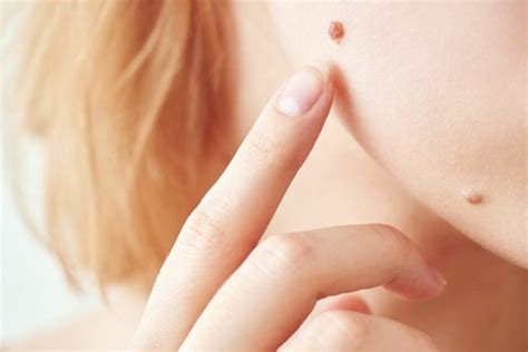 Enlever un grain de beauté raisons précautions et résultats