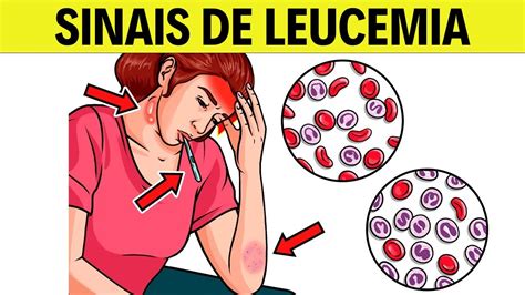 É ASSIM QUE COMEÇA A LEUCEMIA e ninguém lhe diz sinais e sintomas de