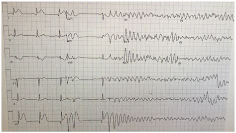 An Ecg A Case For Rapid Access To Ecg For Diagnosis Manitoba Acs Network