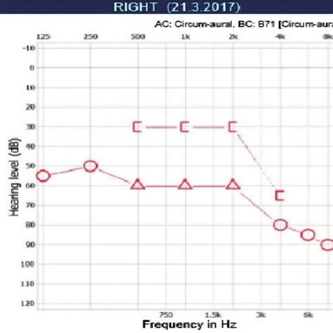 Pure Tone Audiogram Mild To Severe Sensorineural Hearing Loss In The