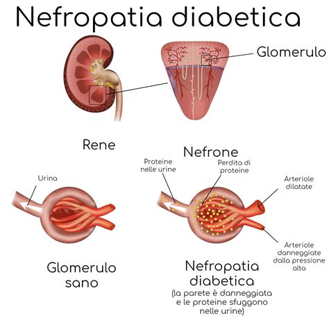 Nefropatia Diabetica Sintomi Pericoli E Rimedi