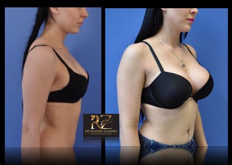 Aumento de busto A 4 meses de su cirugía Ella utilizaba brassiere