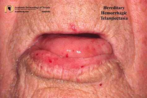 Hereditary Hemorrhagic Telangiectasia Tongue