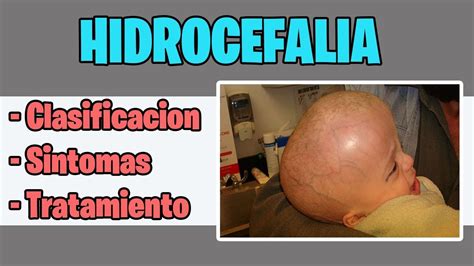 HIDROCEFALIA Que Es CAUSAS SINTOMAS DIAGNOSTICO Y TRATAMIENTO