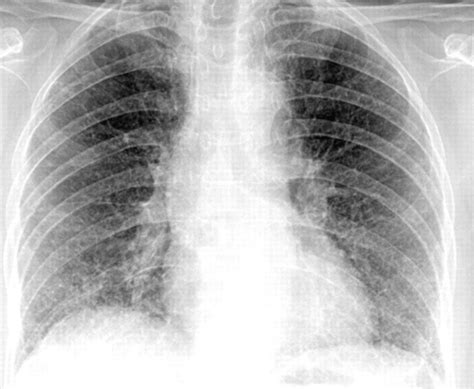 Dsa Neisseria Mycoplasma Rickettsia Chlamydia Spirochetes