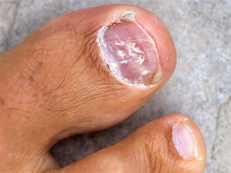 Cracked Toenail Foot Specialist Toronto Feet First Clinic