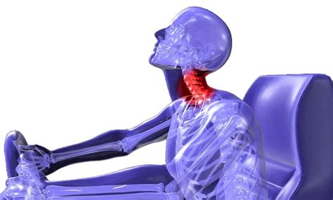 Esguince cervical o latigazo Cómo superarlo con la quiropráctica