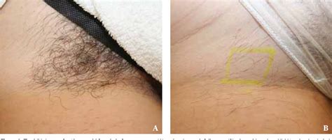 Full Bikini Laser Hair Removal Pictures Outlet Laseb Fae Ufmg Br