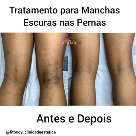 Manchas Escuras nas Pernas Tratamento Clínica Fit Body Estética