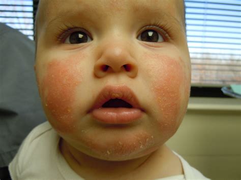 Atopijski Dermatitis EKCEM Roditelji Me