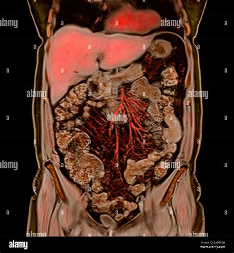 Los órganos abdominales Color coronal 3D imágenes por resonancia