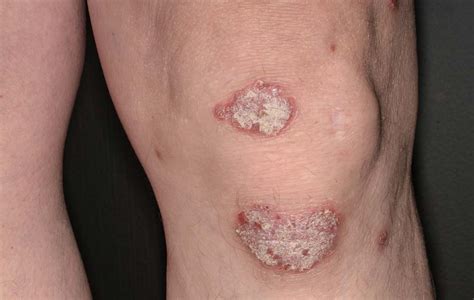 Psoriasis Schuppenflechte Hautarzt München Prof Dr med Gerd