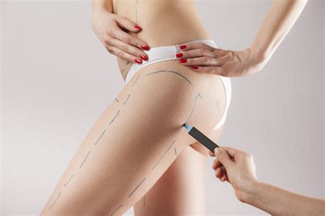 Qué es la lipoescultura y por qué se utiliza Clínica FB