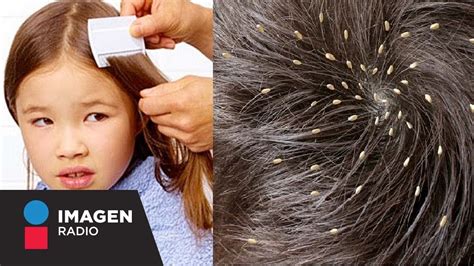 La Forma Mas Sencilla Fácil Y Rápida De Eliminar Los Piojos Y Liendre
