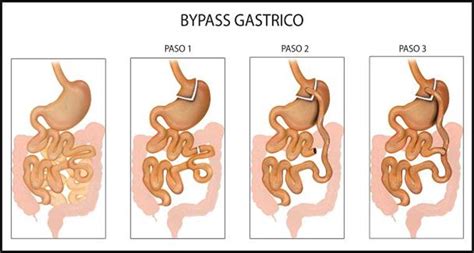 Bypass gástrico Pros y contras ObesiMad