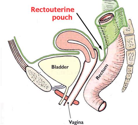 Transverse Cervical Ligament Of Uterus