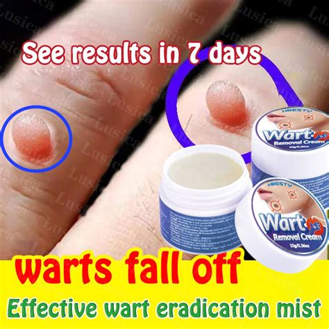Wart Removal Cream Fast Remove Skin Tag Remover Original Ointment