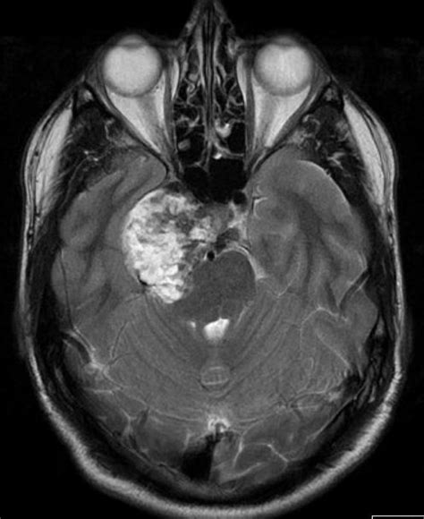 Radiology Of The Pituitary Endotext NCBI Bookshelf