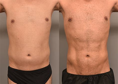What Is Liposuction Recovery Like Thomas P Sterry Md