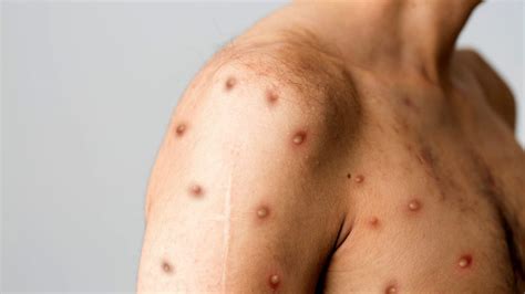 Cómo prevenir la viruela del mono Estas son algunas recomendaciones
