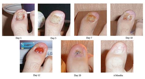 Ingrown Toenail Removal Before And After