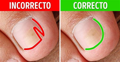 9 Formas efectivas de arreglar las uñas encarnadas en los dedos de los