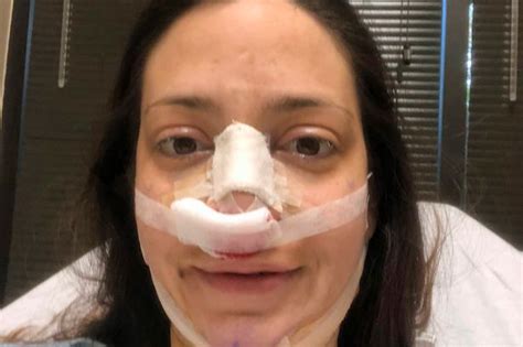 Meghan Markle Wannabe Mum Of 3 Spends 19k On Plastic Surgery To Look