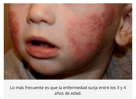 La dermatitis atópica es la patología más común en consultas de