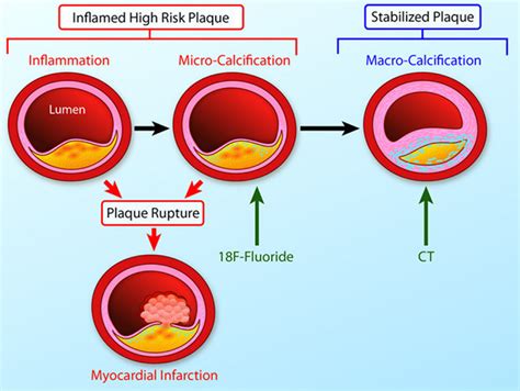 Imaging Cardiovascular Calcification Journal Of The American Heart