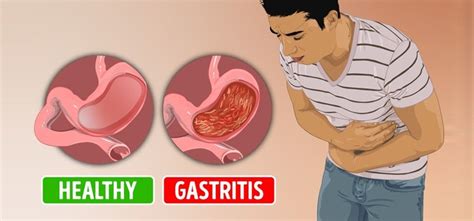 Guest Blog 10 Most Common Symptoms Of Gastritis