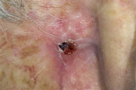 Cancerous Tumor Behind Ear