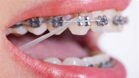 Tipos de ligas para brackets y como cuidarlos Doctor José Lora