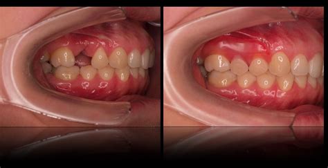 Prótese Dentaria Prótese Removível Prótese Flexível Dr Tadeu Menezes