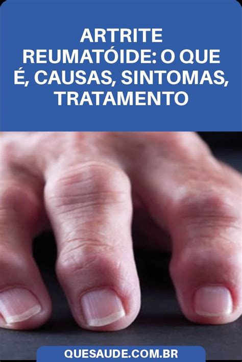 Artrite Reumatóide O Que é Causas Sintomas Tratamento em 2024